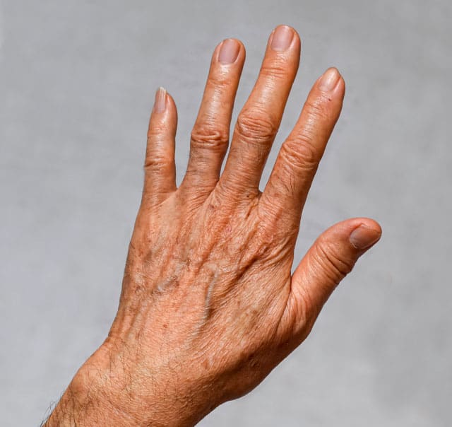 Ageing Hands: Symptoms & Treatment | Face Medical